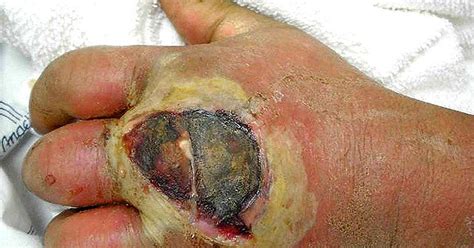 Gross Skin Infections