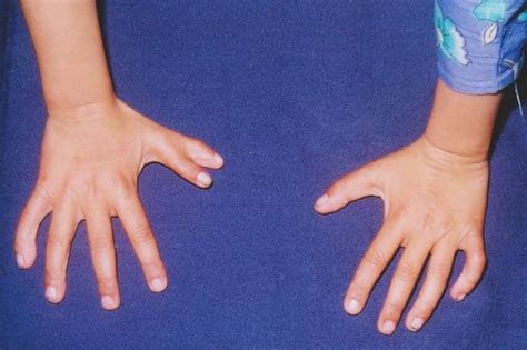 People Who Were Born With Extra Body Parts