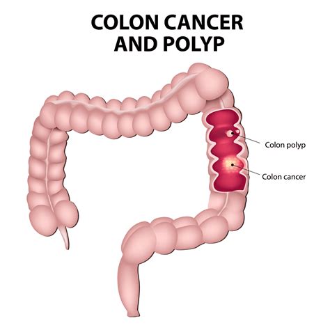 Colorectal Polyps In Singapore Alpha Digestive And Liver Centre