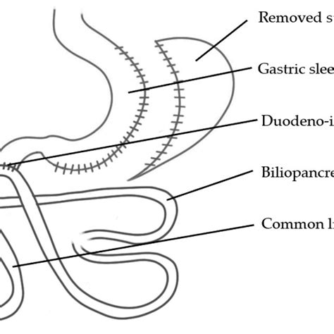Single Anastomosis Duodeno Ileal Bypass Sleeve Gastrectomy Sadi S