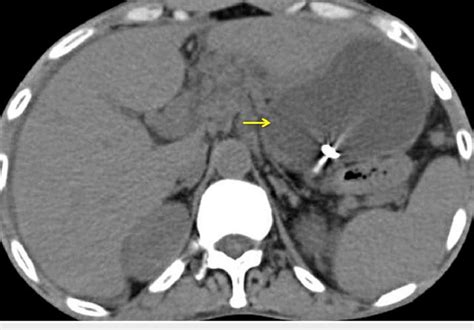 Computed Tomography Axial View Done After The Embolization Showing