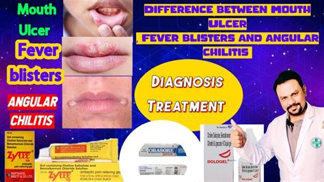 What Is Mouth Ulcer Fever Blisters And Angular Chilitis Diagnosis And