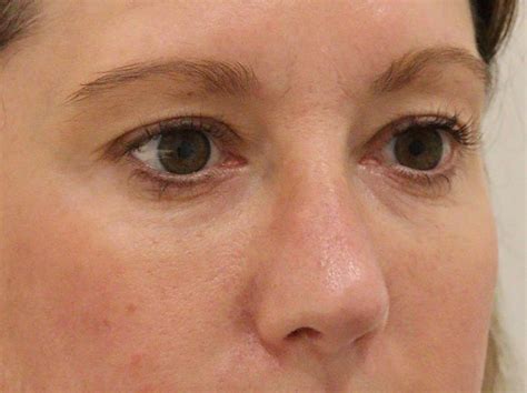 Patient 286166 Nasal Valve Collapse Treatment Before And After Photos