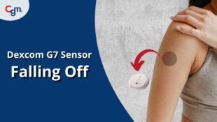 Dexcom G Falling Off Problems Top Tips For Secure Wear