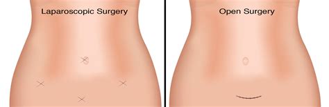 Laparotomy Vs Laparoscopy Full Article Minilaparotomy Vs Laparoscopic