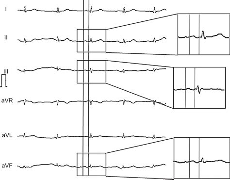 Analysis Of The Association Between Electrocardiographic P Wave Characteristics And Atrial