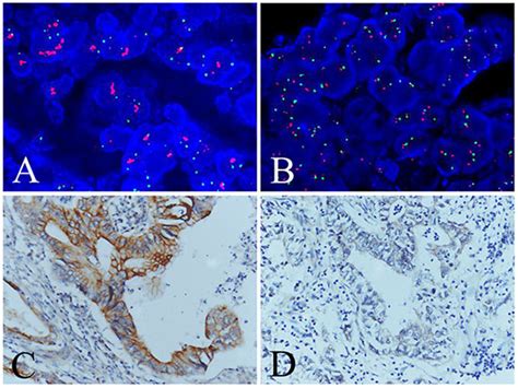 Tmem16a Overexpression Contributes To Tumor Invasion And Poor Prognosis