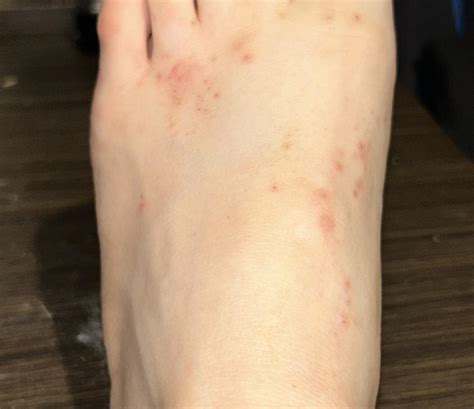 Арьсны өвчтэй хүмүүст зориулсан мэдээлэл Оройн мэнд хөлөн дээр биржгэр юм гараад орой унтах