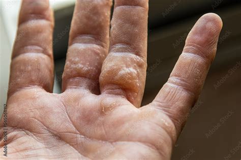 Plakát Rash On Fingers Dyshidrotic Eczema Obraz Na Zeď Posterscz