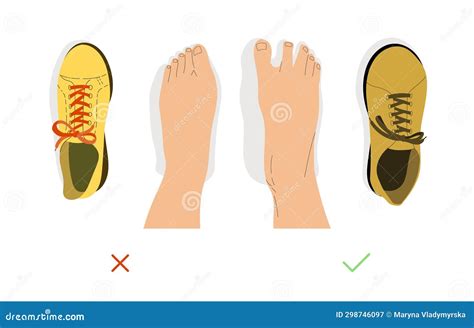 Top View Comparison Of Healthy And Deformed Feet After Wearing Regular