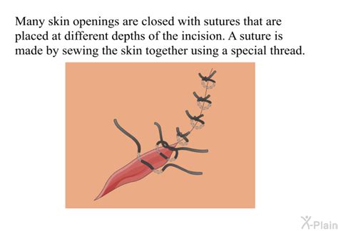 Incision Care