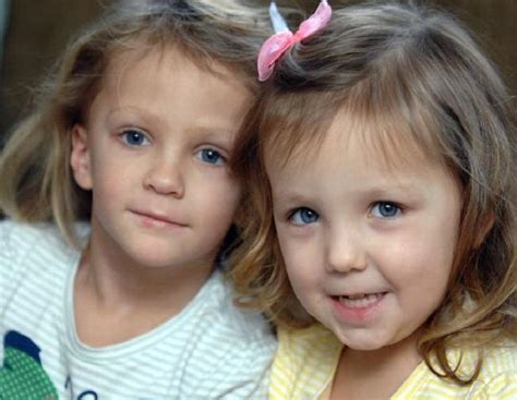 Turner Syndrome Symptoms Causes Diagnosis And Treatment Natural