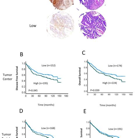 MRE11 Expression In Colorectal Cancer CRC Tissue Samples A