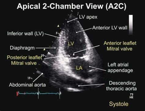 Apical 2 Chamber View Tee Diagnostic Medical Sonography Medical