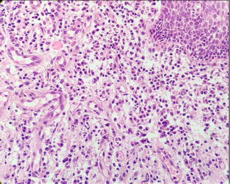 Plasma Cell Vulvitis A Rare Vulvar Dermatoses Indian Journal Of