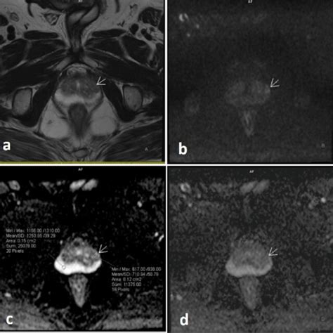 A 55 Year Old Male Patient Whose Serum Psa Level Was 5 6 Ng Ml A On Download Scientific