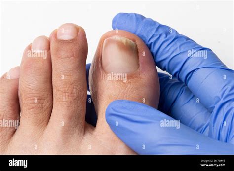 Close Up Image Of The Doctor Who Controls The Left Toe That Suffers A