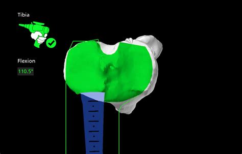 Stryker Mako Robotic Technology Chris Bailey Orthopaedics