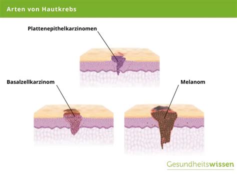 Hautkrebs Diagnose Ursache Behandlung Und Hautkrebs Screening