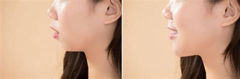 Mandibular Reconstruction Dr Nitin Tomar Mandibular Reconstruction