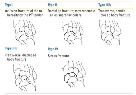 Navicular Fracture Classification Flashcards Quizlet