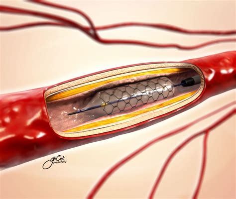 Understanding Peripheral Vascular Disease