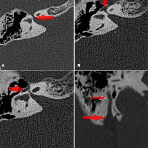 AD CT Images Of The Right Temporal Bone Scan A Axial CT Section Download Scientific Diagram