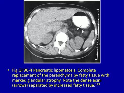 90 Fatty Lesions In The Abdomen And Pelvis Ppt