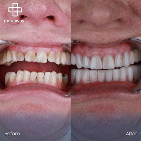 Turkey Teeth Before And After Up To 15 Off Packages Medaway