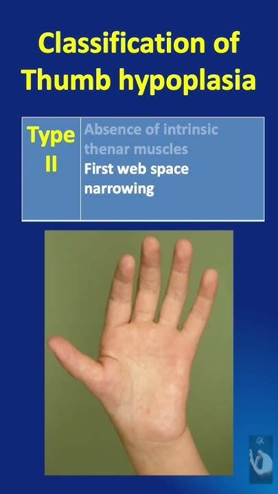 Shorts 99 Classification Of Thumb Hypoplasia Modified Blauth