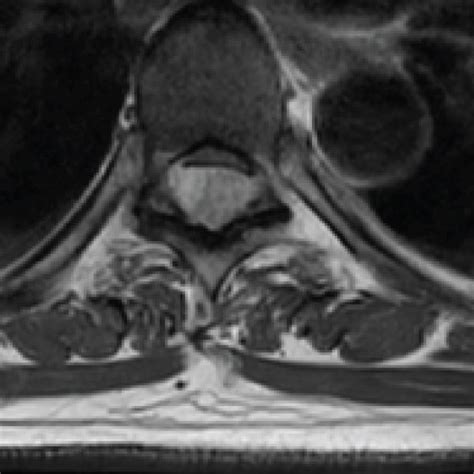 Preoperative Thoracic Mri A Heterogeneous Epidural Posterior Mass