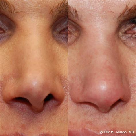 Eric M Joseph Md Permanent Non Surgical Rhinoplasty Before And After