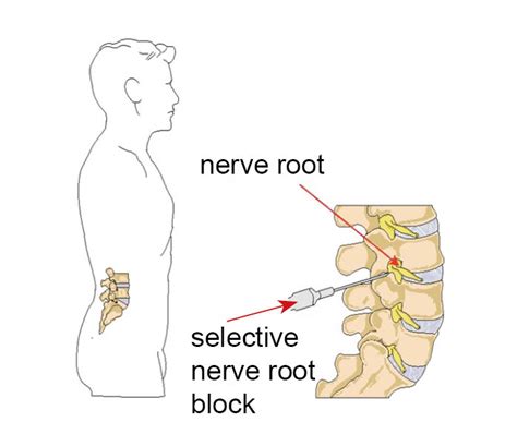 Nerve Root Block Injections Transforaminal Epidural And Dorsal Root Ganglion Blocks The Kent