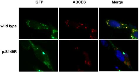 S149r A Novel Mutation In The Abcd1 Gene Causing X Linked Adrenoleukodystrophy Oncotarget