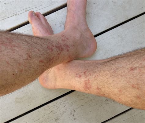 Rash On Legs From Hiking Printable Templates Protal