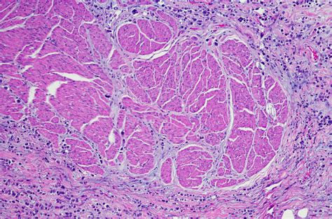 Profiling Colorectal Cancer With Single Cell Transcriptomics