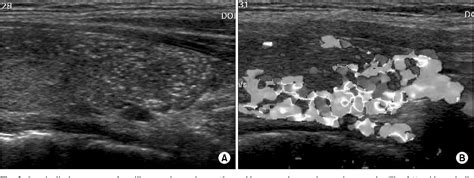 Figure 1 From Clinical Analysis Of Macrocalcifications Accompanying A Thyroid Nodule A