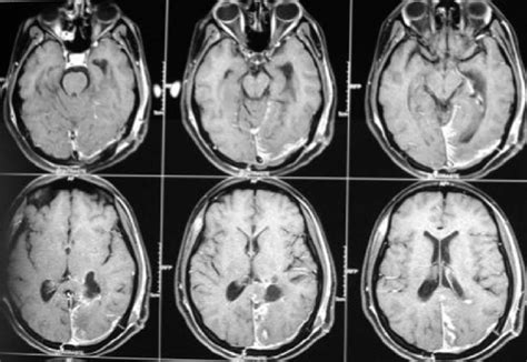 Postoperative Magnetic Resonance Imaging Download Scientific Diagram