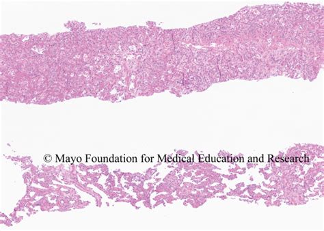 Liver Angiosarcoma Mayo Clinic Proceedings