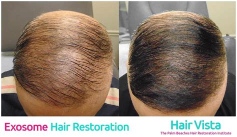 Exosomes Hair Restoration Hair Vista Prp Hair Restoration West Palm Beach