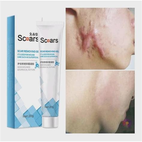 Pomada Gel Tira Remove Cicatriz Queloide Scoars g em Promoção na Americanas