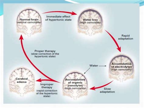 Hypernatremia Ppt