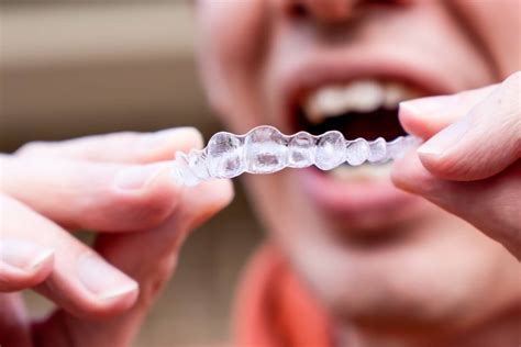 A Guide Oral Health With Clearcorrect Retainer Braces