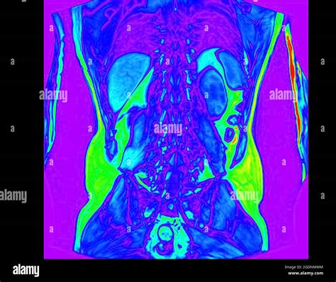 Frontal Abdomen Mri Scan Of A 60 Year Old Male Patient This Patient