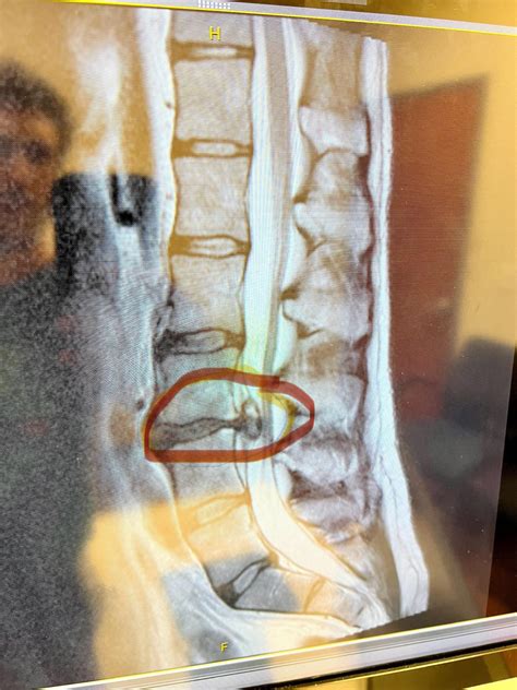 Is This Bad R Sciatica