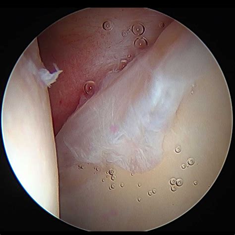 Hip Labrum Tear Frayed Labrum Hip Specialist Manhattan New York