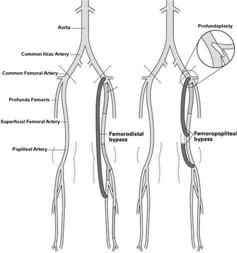 Femoral Artery A Femoralis The Arteries Of The Lower