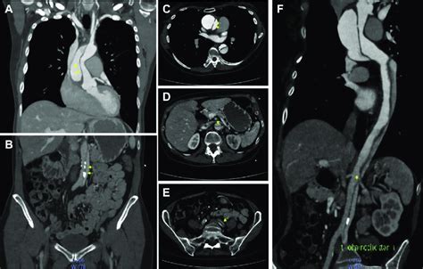 A F Computed Tomography Ct Showed Type A Aortic Dissection Arrows
