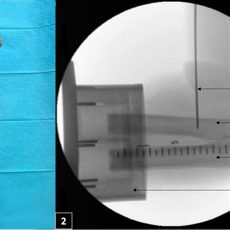 Generation Of Valgus Stress At The Specimens Elbow Joint By Extending Download Scientific