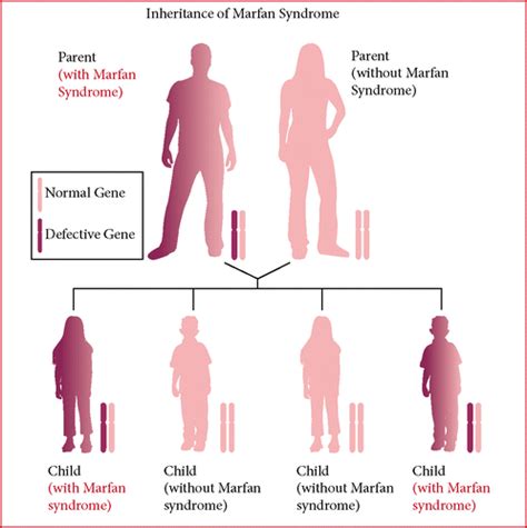 Marfan Syndrome Is A Genetic Disorder Associated With Tissue Pregnant Health Tips